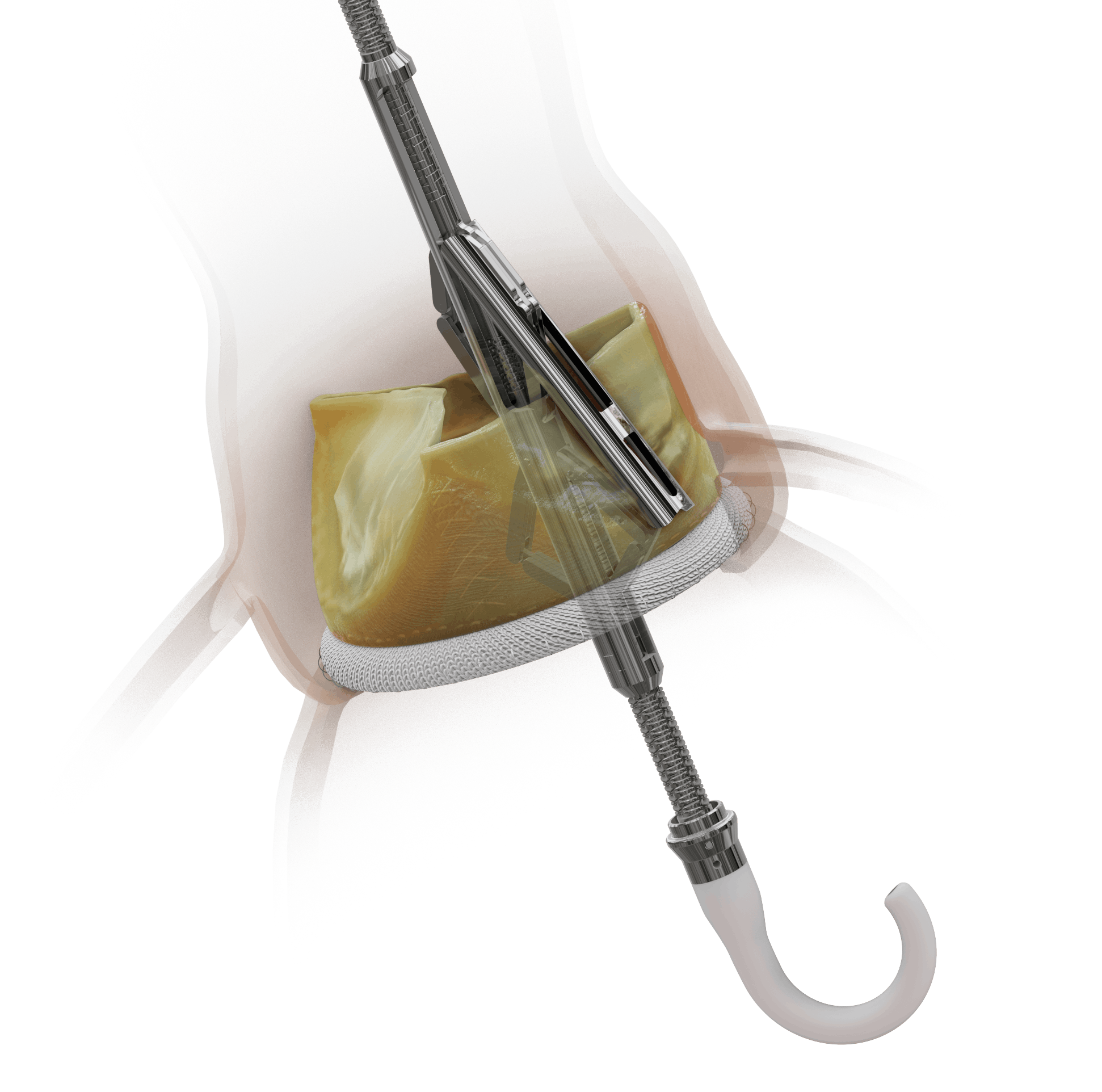 Pi-Cardia’s ShortCut Leaflet Modification Device for TAVR Used in First ...